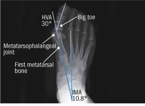 The Importance Of Intrinsic Muscle Exercises In The Management Of ...